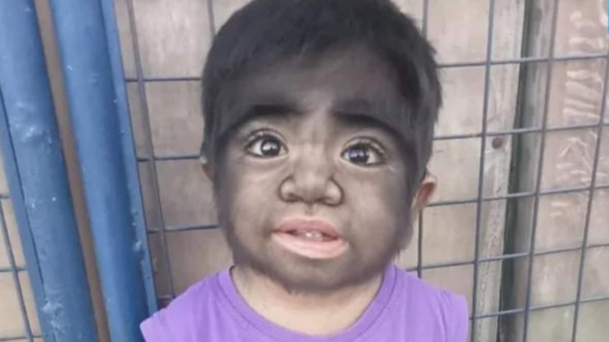 Spain Reports 11 Cases Of 'Werewolf Syndrome' Linked To Minoxidil ...