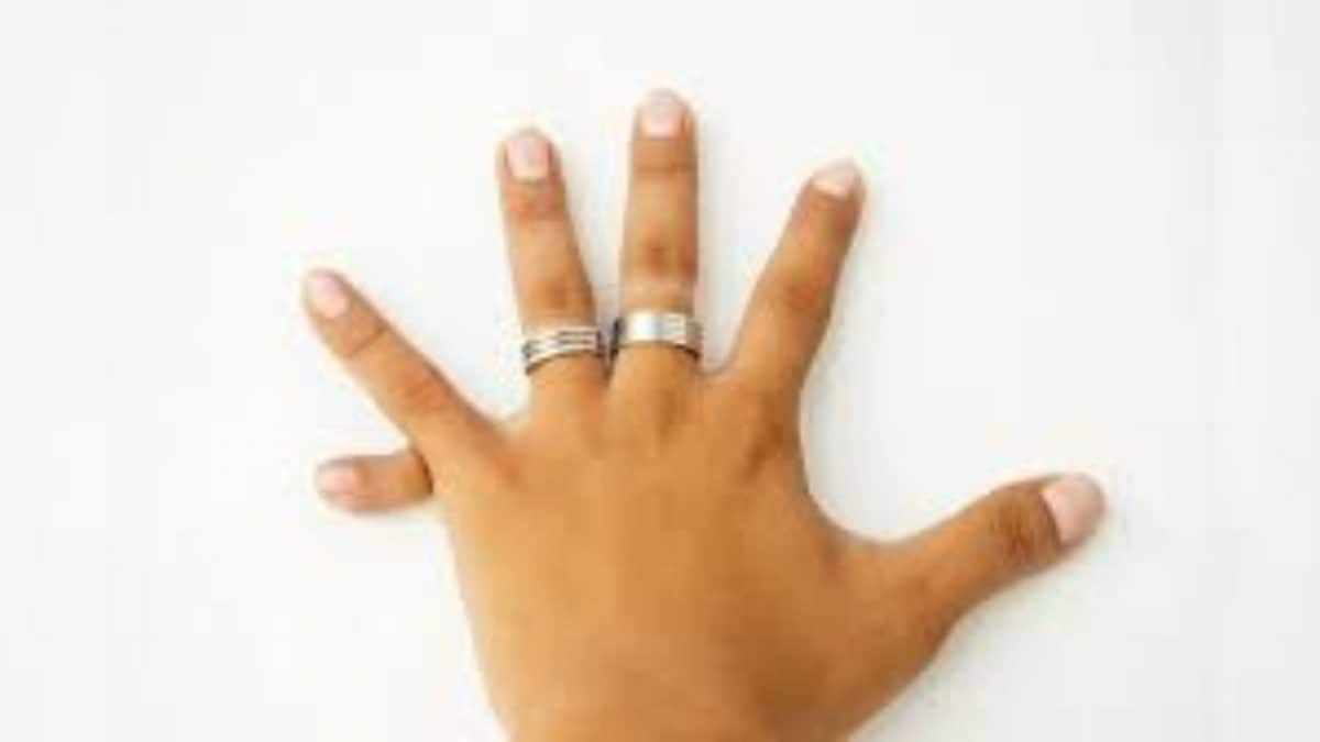 What Is Polydactyly? The Science And Mystery Behind Having Six Fingers ...