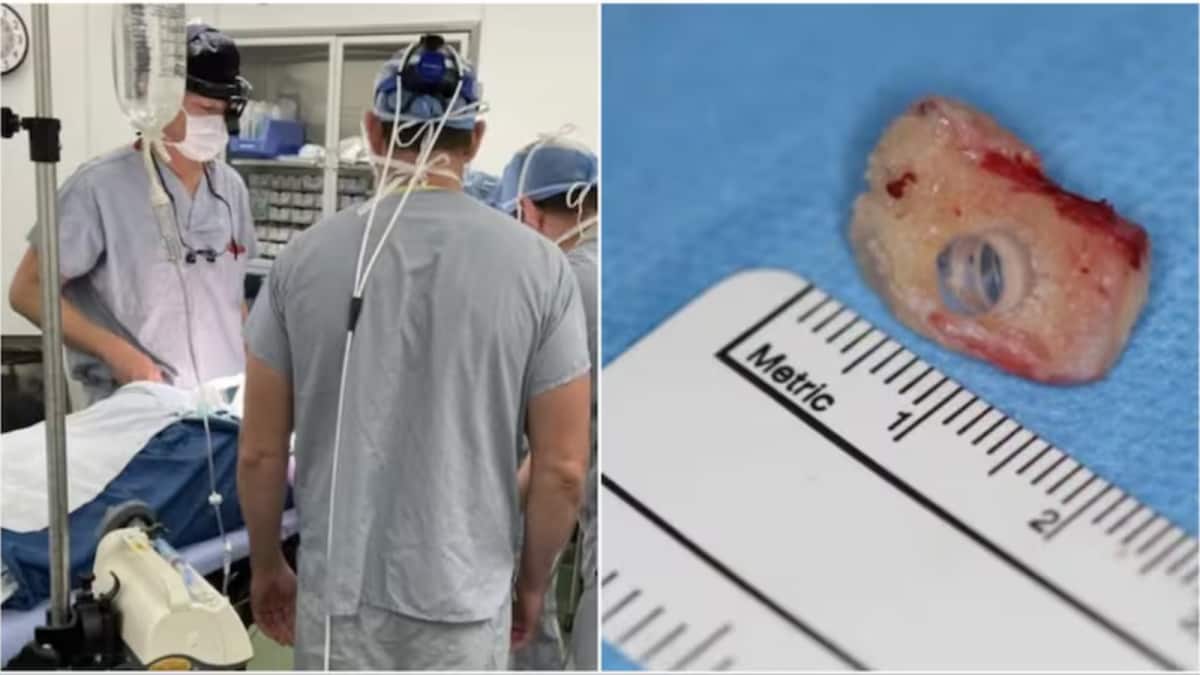 Canada Woman, Blind For A Decade, Gets Her Tooth Implanted In Eye To ...