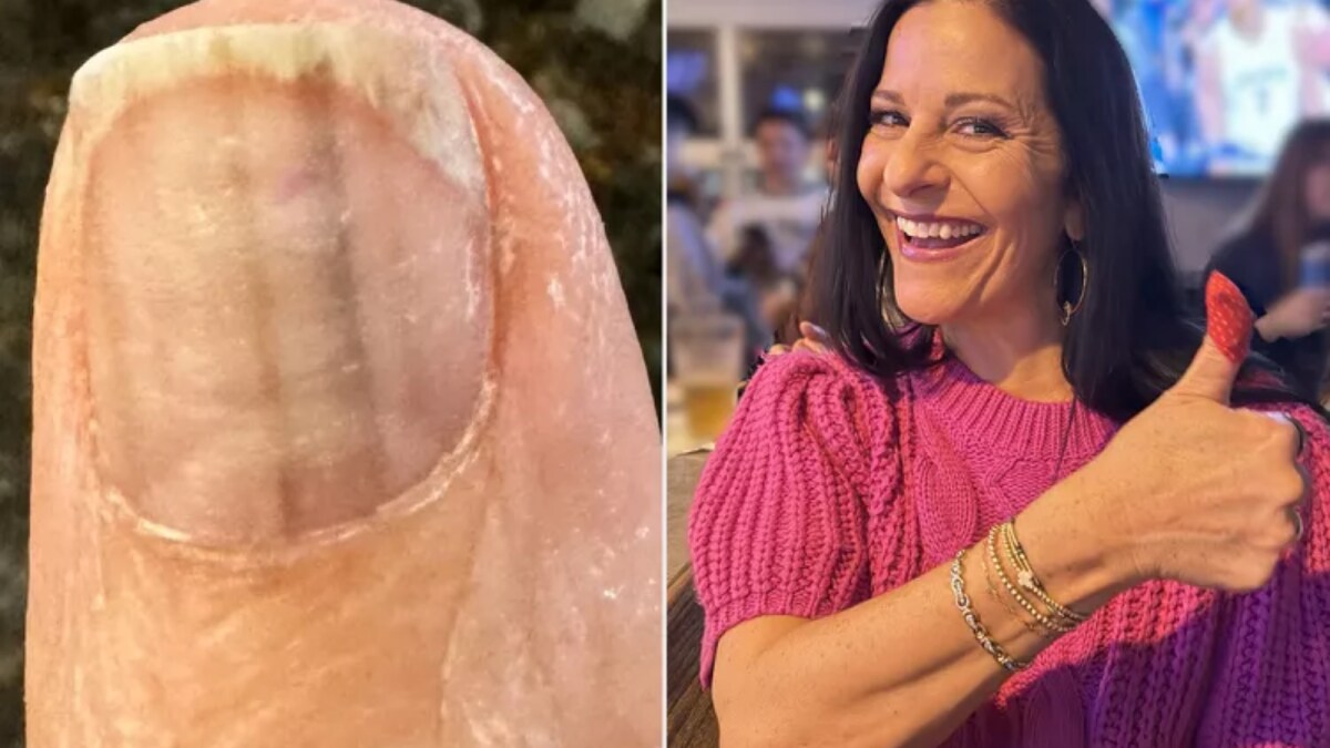 Ohio Woman Discovers Black Lines On Nails, Finds Out It’s Early-Stage ...