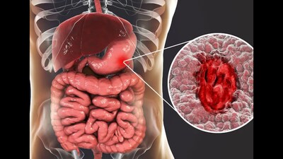 Your Gut Could Be In Danger: How Common Painkillers Are Silently ...