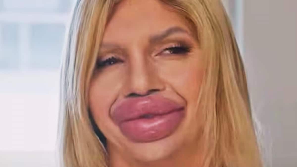 This Woman Spent Rs 39 Lakh To Have The 'Biggest Lips In The World ...