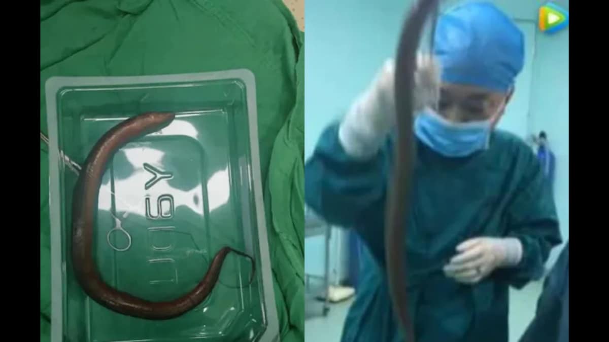1-Foot-Long Eel-Like Creature Found Alive Inside Chinese Man's Stomach ...
