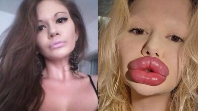 'My Body, My Choice': Before-And-After Pics Of Influencer With ‘World’s Biggest Lips’ Go Viral ...