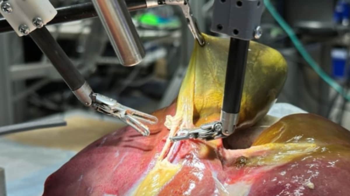 AI Robot Performs Gallbladder Surgery, Leaves Researchers Amazed ...