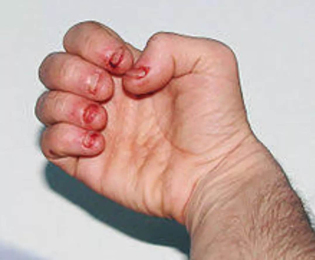 Rare Diseases: RPI Deficiency, Field’s Disease, HGPS, Kuru & More Explained