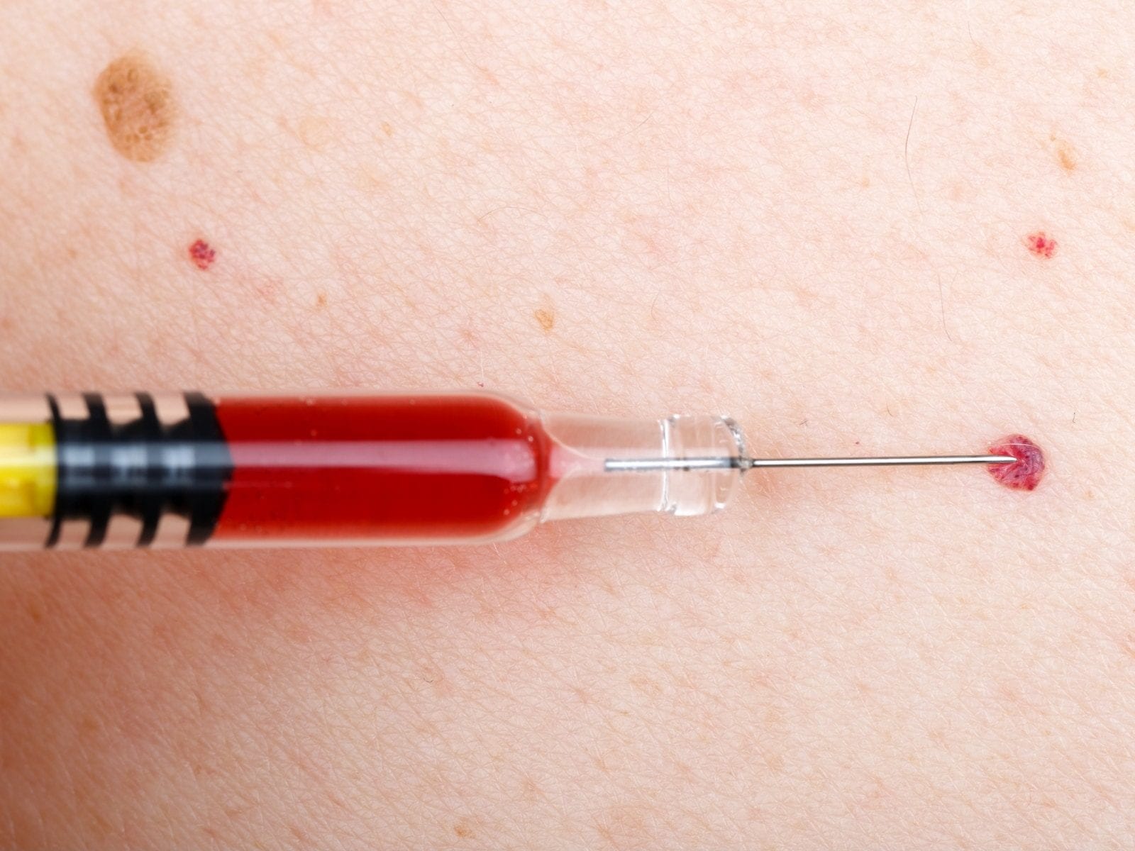 Cherry Angioma: What Causes These Red Moles And Are They Dangerous?