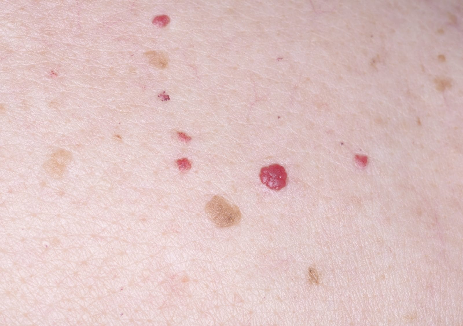 Cherry Angioma: What Causes These Red Moles And Are They Dangerous?