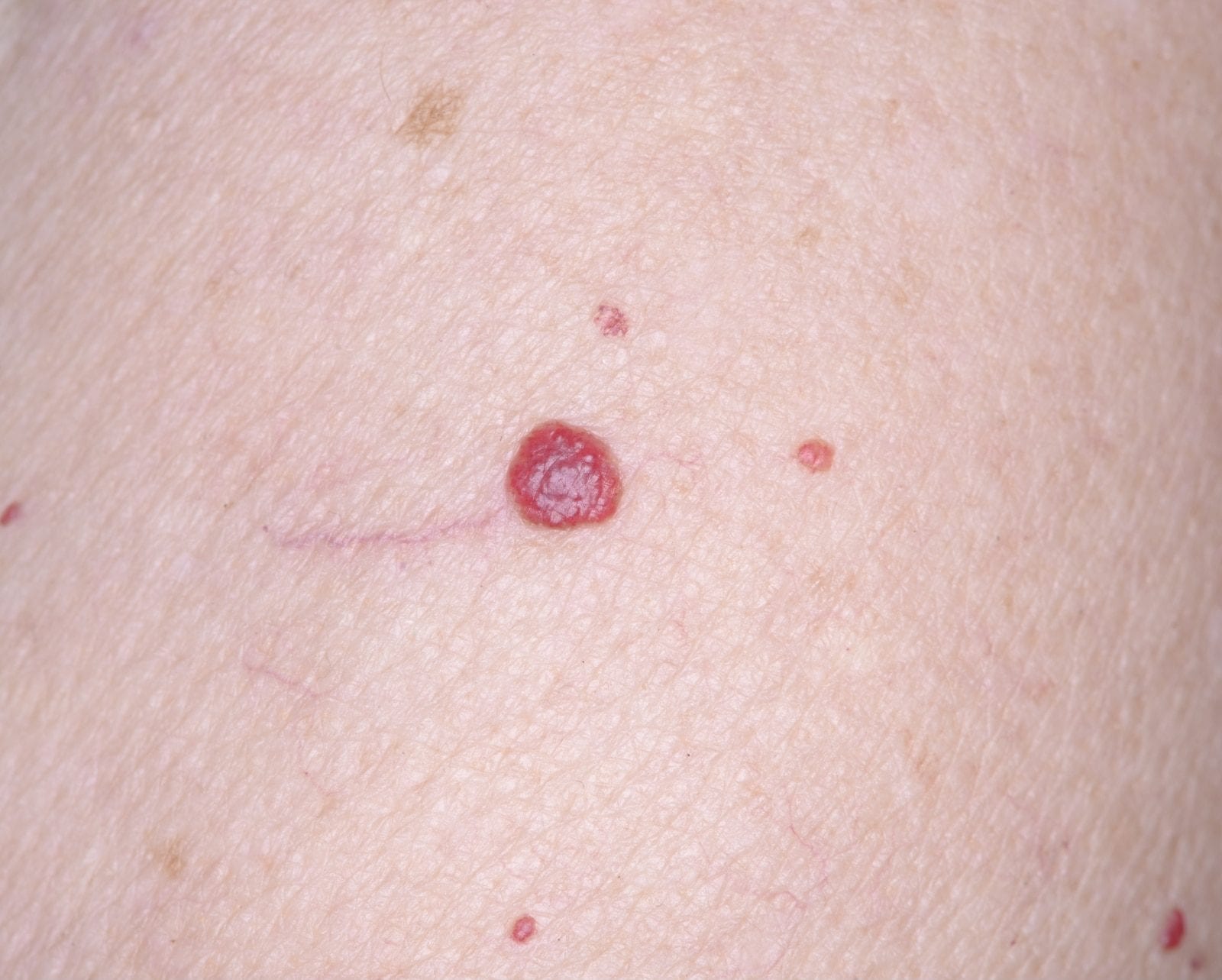Cherry Angioma: What Causes These Red Moles And Are They Dangerous?