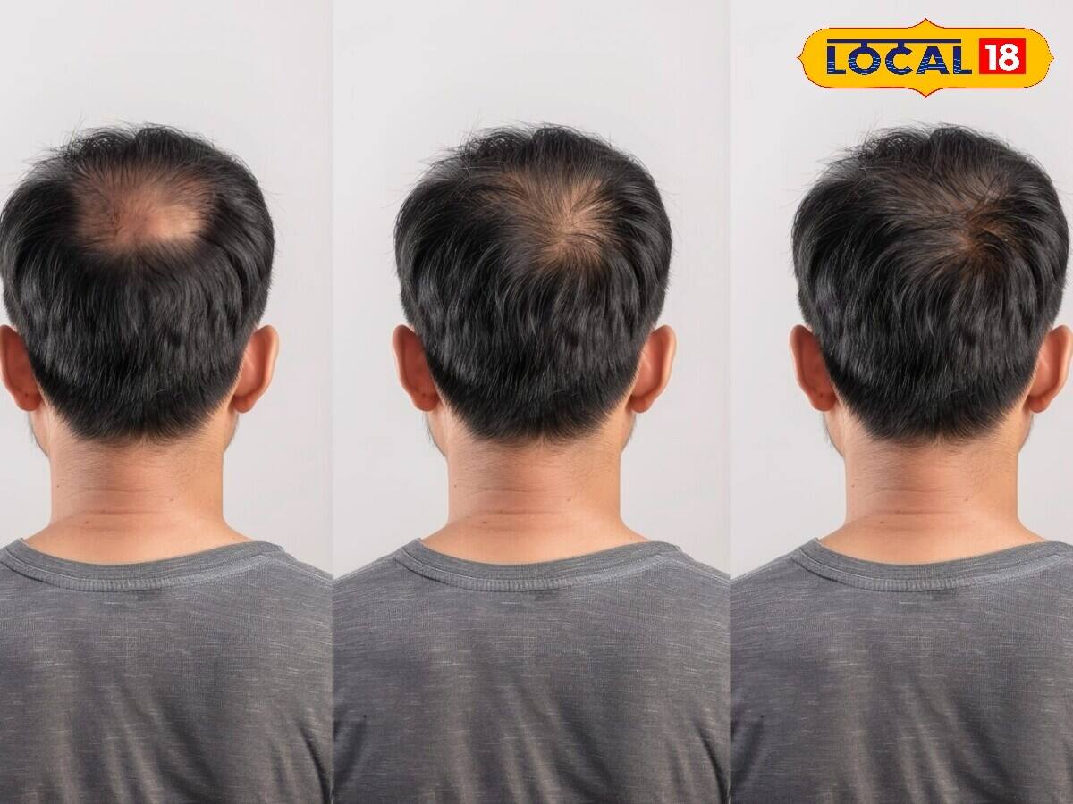 Permanent Cure For Baldness? All About Viral Serum Promising Hair ...