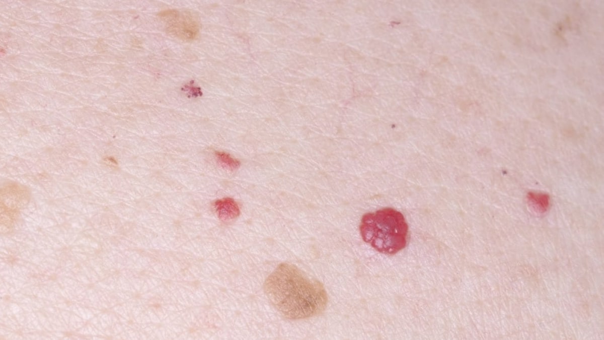 Cherry Angioma: What Causes These Red Moles And Are They Dangerous?