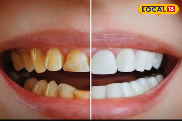 yellow teeth stronger