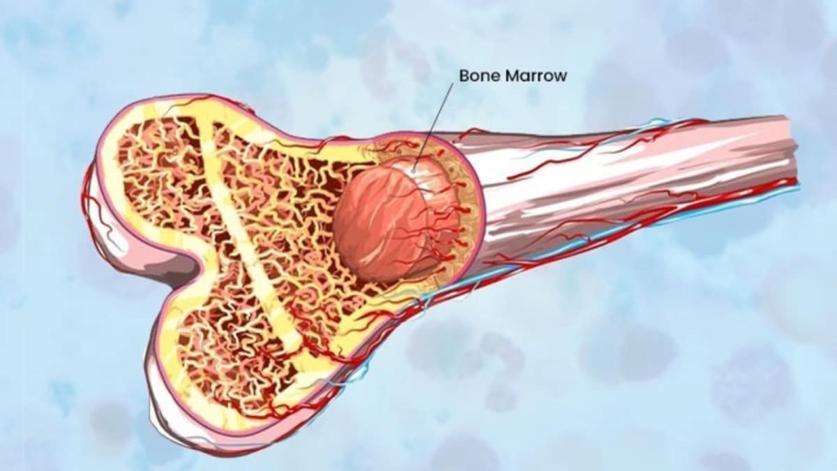 Early Bone Marrow Failure: Why Fatigue And Recurrent Infections Should ...