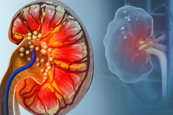 Kidney Stones News: Latest Kidney Stones News and Updates at News18