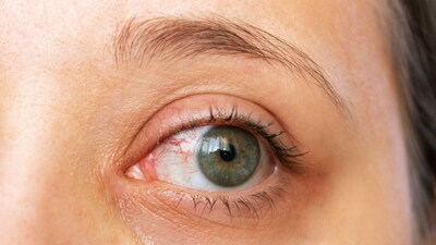 Minor Eye Irritation Or Something Serious? Warning Signs You Shouldn’t ...