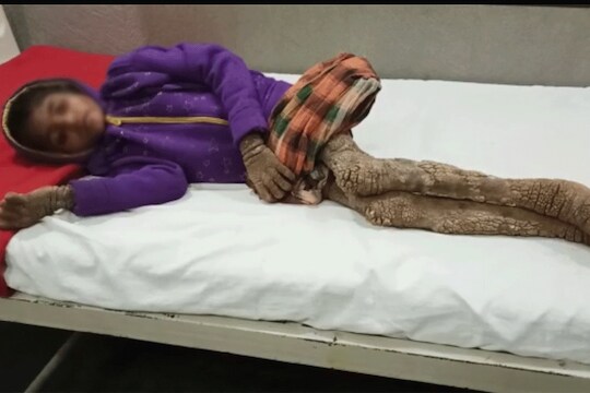 बापरे ! मुलगी की झाडाचं खोड; दुर्गम भागातल्या 8 वर्षांच्या चिमुरडीची ...