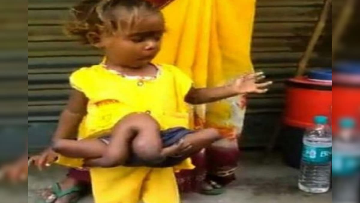 The girl was born with four legs and four arms the doctor was shocked ...