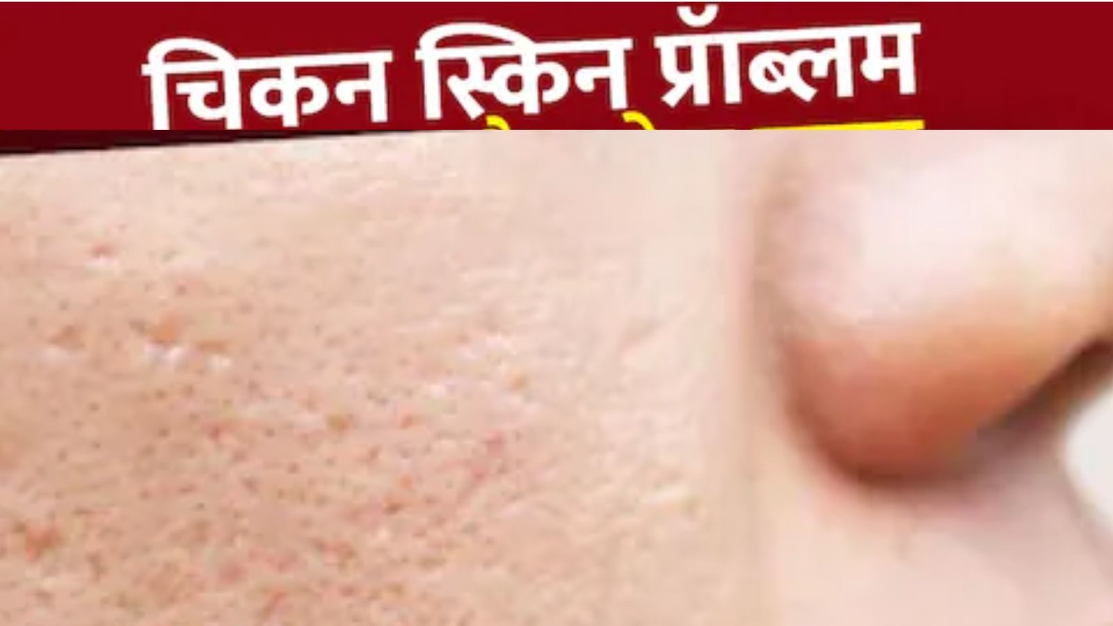 What is chicken skin problem? home remedies to get smooth and beautiful ...