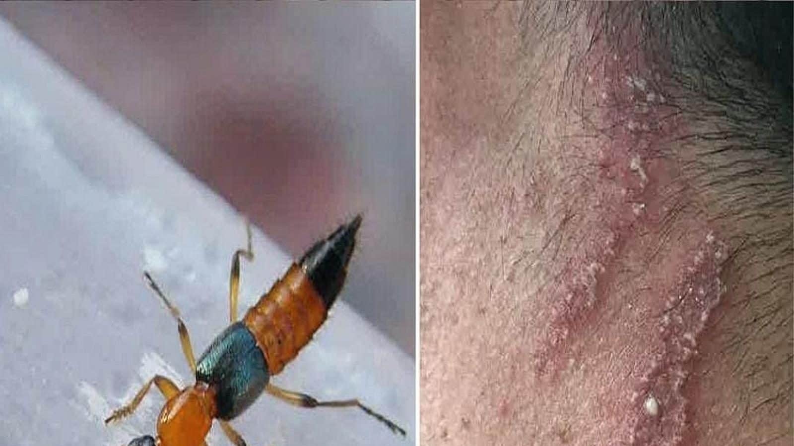What is Nairobi Fly Nairobi Flies Burns Skin of Sikkim Students ’ What ...