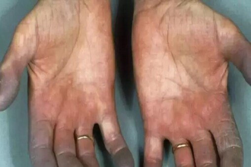 new burger disease appeared in tobacco eaters careful | ತಂಬಾಕು ಸೇವನೆ ...