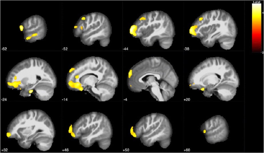 Brain Mapping Test: ಬೆಂಗಳೂರಿಗೆ ಬಂತು ಬ್ರೇನ್ ಮ್ಯಾಪಿಂಗ್ ಟೆಸ್ಟ್ ...