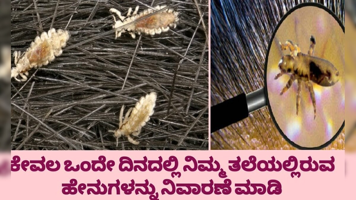 Home remedy for Lice: ಅಯ್ಯೋ, ಹೇನಿನಿಂದ ತಲೆ ತುಂಬಾ ತುರಿಸ್ತಾ ಇದೆ ಏನ್ ಮಾಡೋದು ...