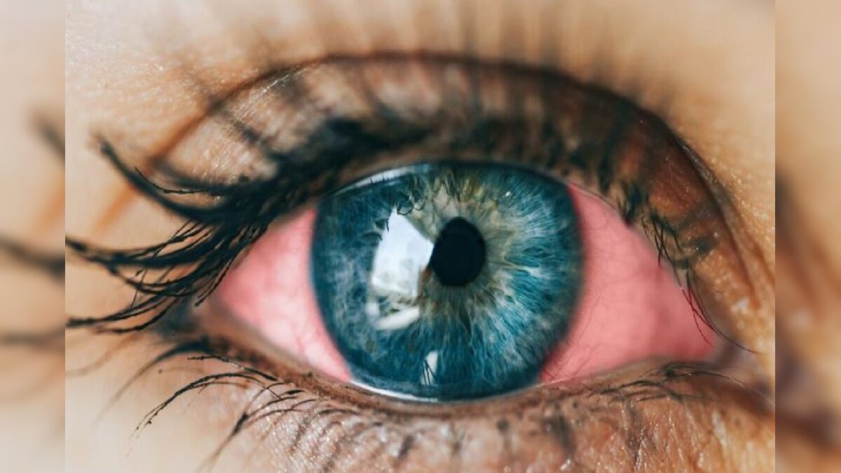 Eye Health: ನಿಮ್ಮ ಕಣ್ಣಿನ ದೃಷ್ಟಿ ಚುರುಕುಗೊಳ್ಳಬೇಕೇ? ಈ ಆಹಾರಗಳನ್ನು ಪ್ರತಿದಿನ ...