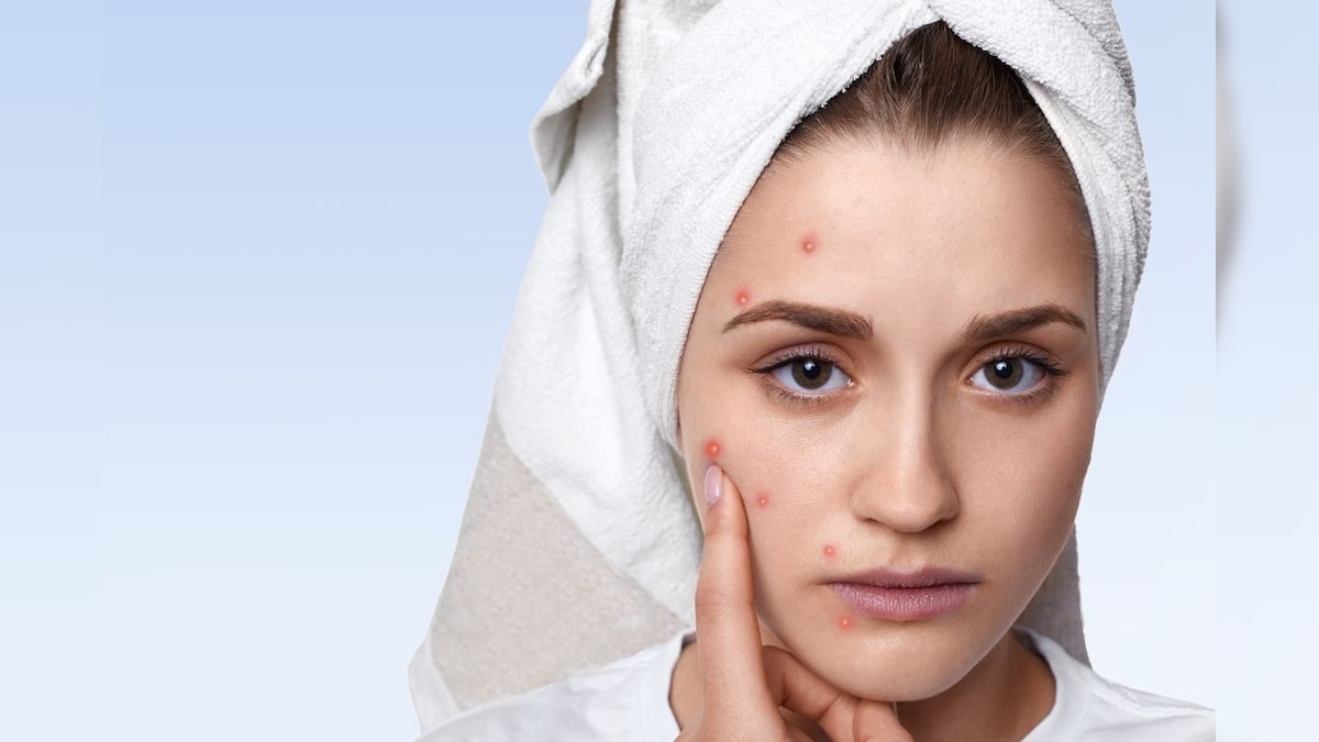 ಉಗುಳಿನಿಂದ ಮೊಡವೆ ಮುಕ್ತಿ? ಈ ವಿಚಾರ ತಿಳಿದ್ರೆ ನಿಮಗೆ ಶಾಕ್ ಆಗಬಹುದು! | Does ...