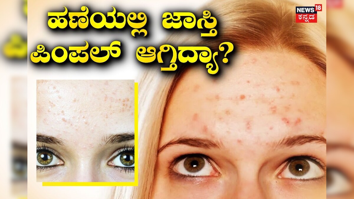 Forhead Pimple: ಪದೇ ಪದೇ ಹಣೆಯಲ್ಲಿ ಪಿಂಪಲ್ ಆಗ್ತಿದ್ಯಾ? ಹುಷಾರ್, ದೇಹದ ಆ ಭಾಗ ...