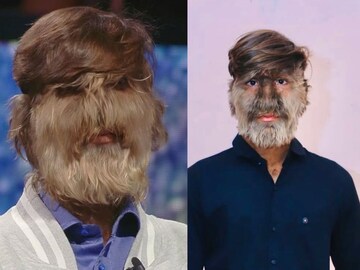 Werewolf Syndrome: ಕಾಯಿಲೆಯಿಂದಲೇ ಗಿನ್ನೆಸ್ ದಾಖಲೆ ಪುಟ ಸೇರಿದ 'ತೋಳ ಮಾನವ' | Lalit Patidar sets ...