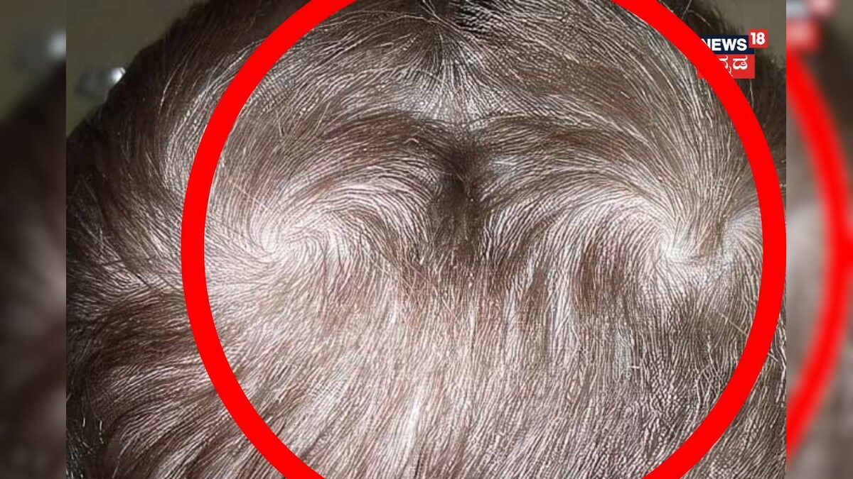 Double Crown Hair: ಎರಡು ಸುಳಿ ಇದ್ದರೆ ಎರಡು ಮದುವೆ ಗ್ಯಾರಂಟಿನಾ? ಜ್ಯೋತಿಷಿಗಳು ...
