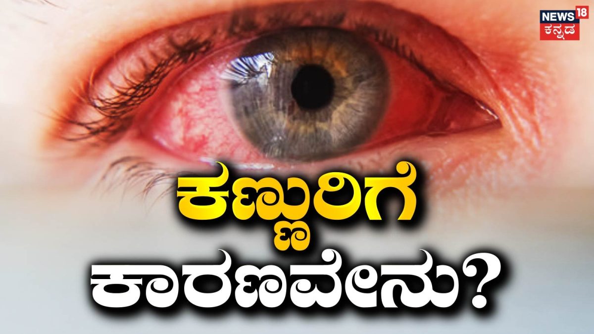 Burining Eye: ಬೇಸಿಗೆ ಶುರುವಾಗ್ತಿದ್ದಂತೆ ಕಣ್ಣುಗಳು ಸಿಕ್ಕಾಪಟ್ಟೆ ಉರಿಯೋದ್ಯಾಕೆ ...