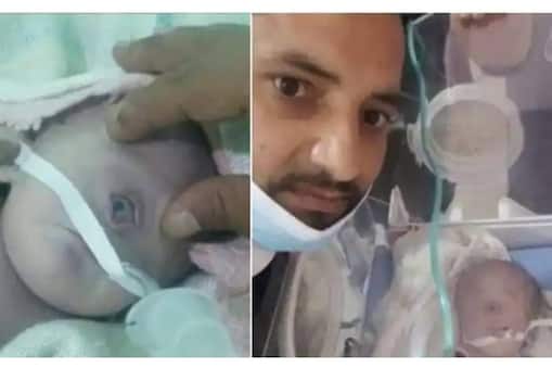 One-eyed baby |ഒരു കണ്ണുമായി ജനിച്ച കുഞ്ഞ് ഏഴു മണിക്കൂറുകള്‍ക്ക് ശേഷം ...
