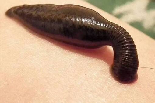 രണ്ടുമണിക്കൂറോളം വെള്ളത്തിലിറങ്ങിയ അറുപതുകാരന്റെ മലദ്വാരത്തിൽ ഭീമ ...