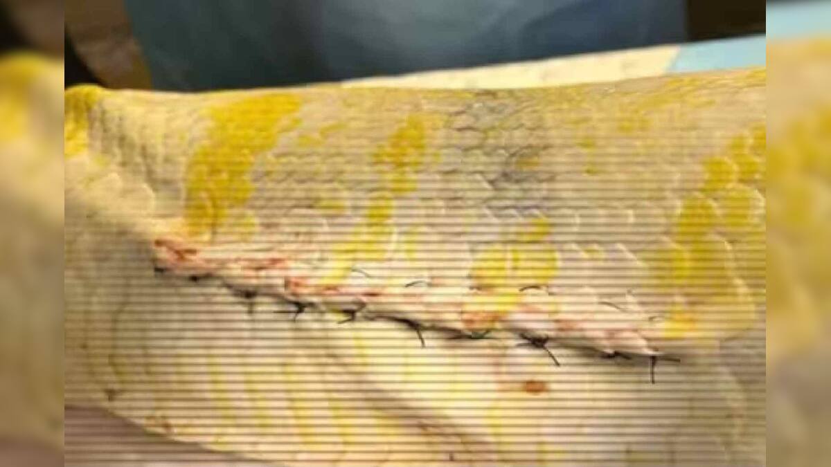 ബര്‍മ്മീസ് പെരുമ്പാമ്പിനെ ശസ്ത്രക്രിയയ്ക്ക് വിധേയമാക്കി സുഖപ്പെടുത്തി ...