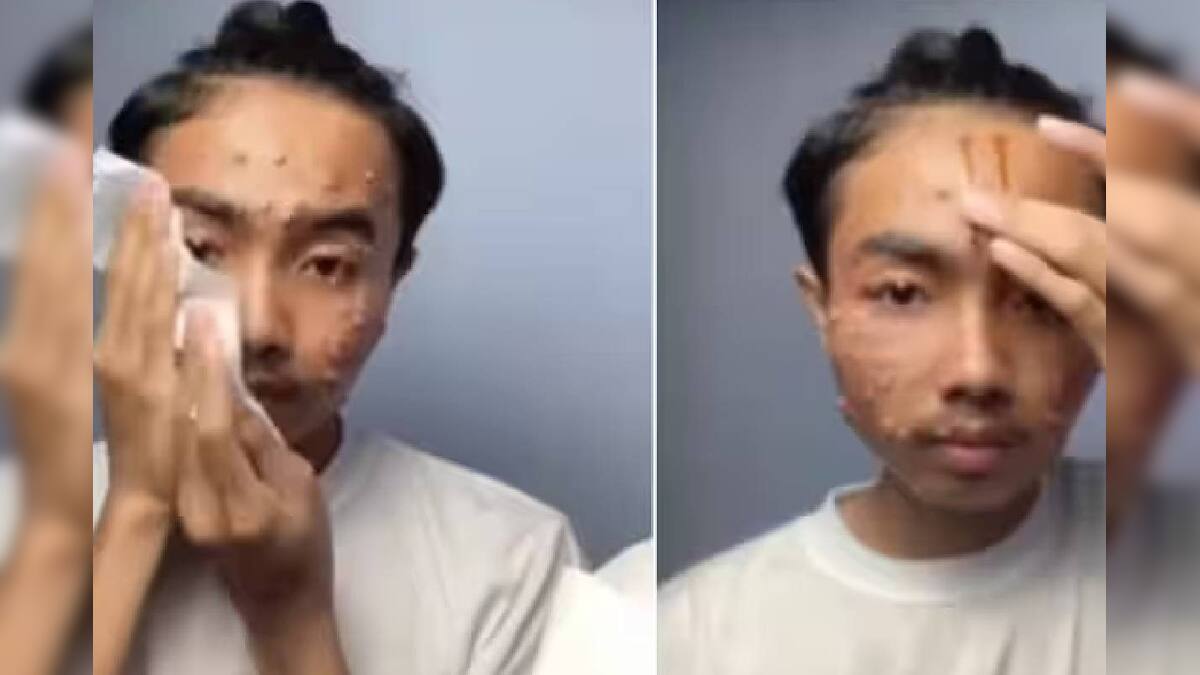 സെക്കൻ്റ് ഹാൻഡ് വാങ്ങിയ തുണി കഴുകാതെ ഉപയോഗിച്ച യുവാവിന് മുഖത്ത് അണുബാധ ...