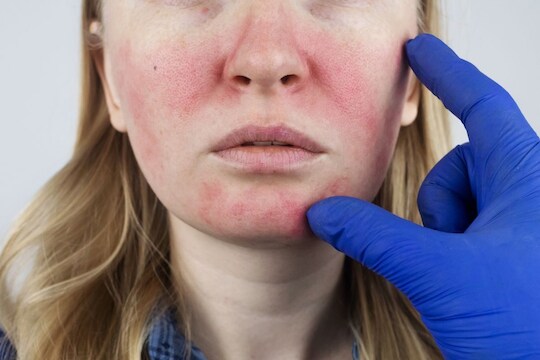 त्वचेवर लाल पुरळ, खाज येण्याच्या समस्येला करु नका दुर्लक्ष; ‘या ...