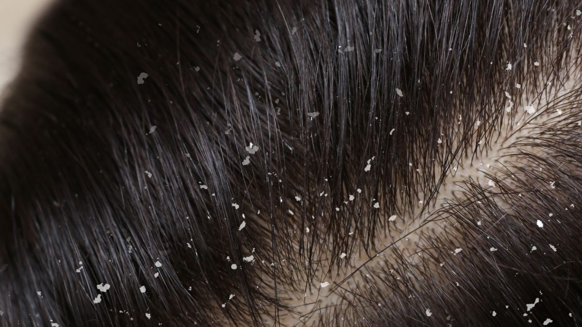Dandruff : केसातला कोंडा कसा घालवायचा ? वापरुन पाहा सोपे आणि सहज उपाय ...