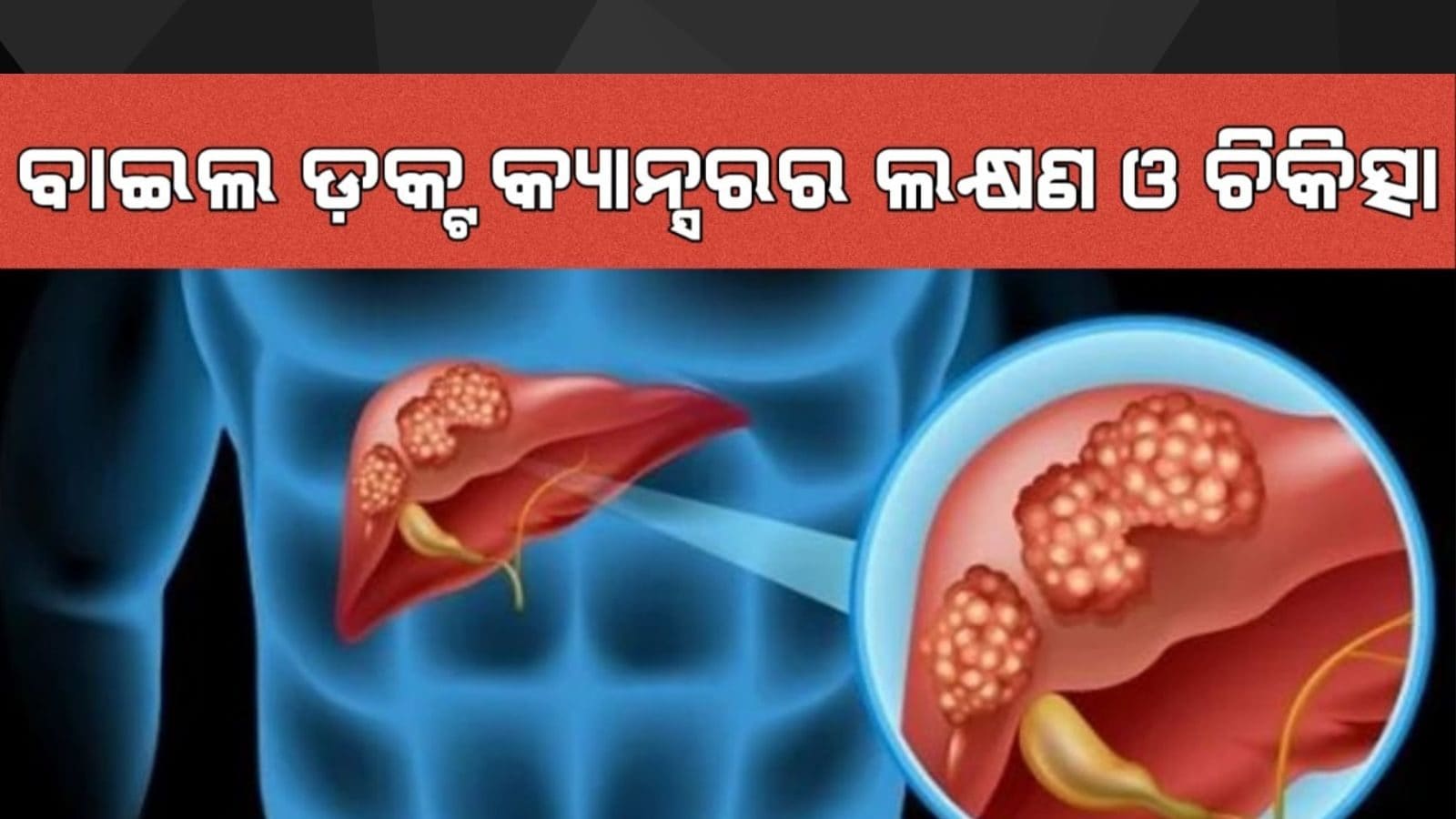 Know Everything About Bile Duct Cancer Symptoms Treatment Bile Duct