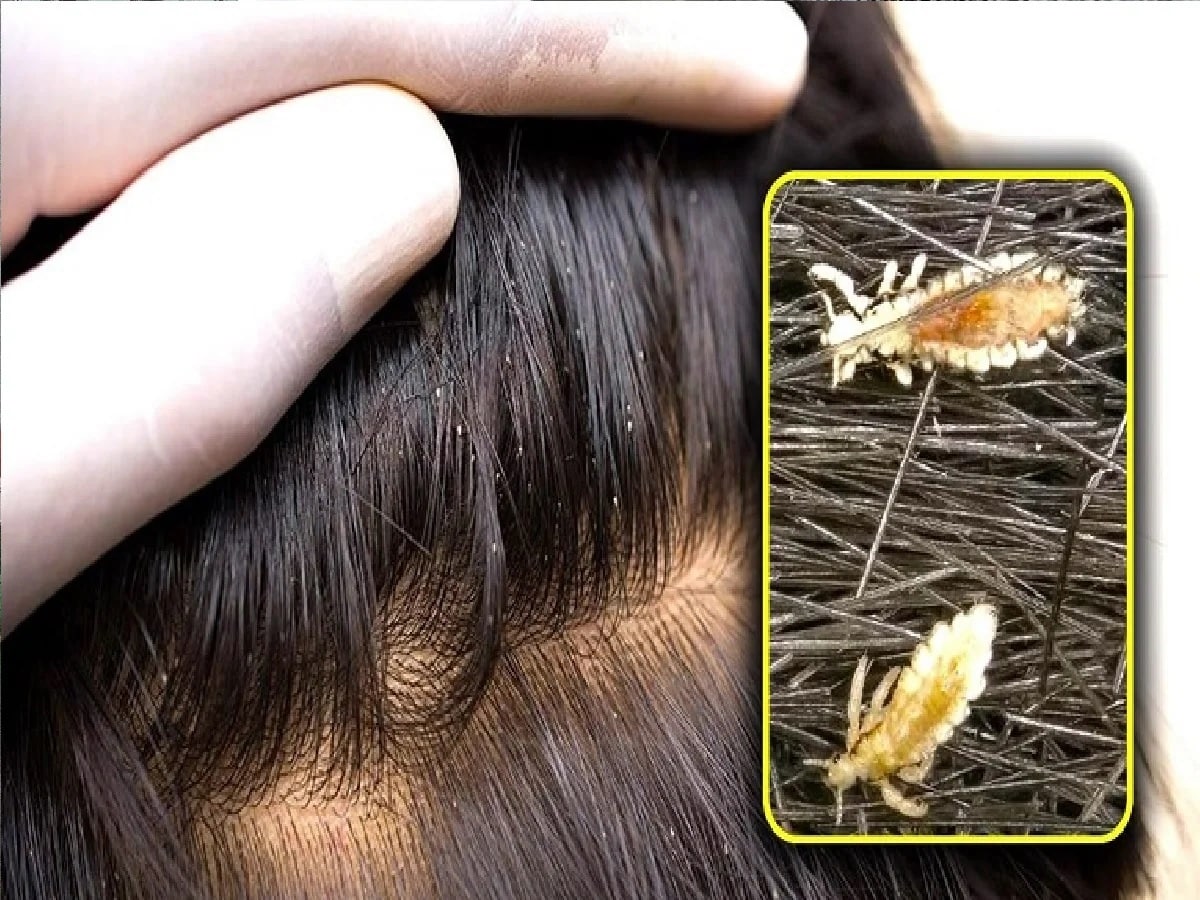 Hair Care:ମୁଣ୍ଡରେ ଉକୁଣି କେଉଁଠୁ ଆସନ୍ତି ? ଜାଣନ୍ତୁ...where do lice come ...