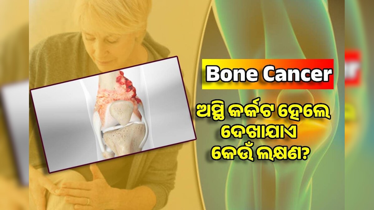 Bone Cancer: ଅସ୍ଥି କ୍ୟାନ୍ସର ଥରେ ହେଲେ କମିଯାଏ ବଞ୍ଚିବାର ଆଶଙ୍କା! ପ୍ରାରମ୍ଭରୁ ...