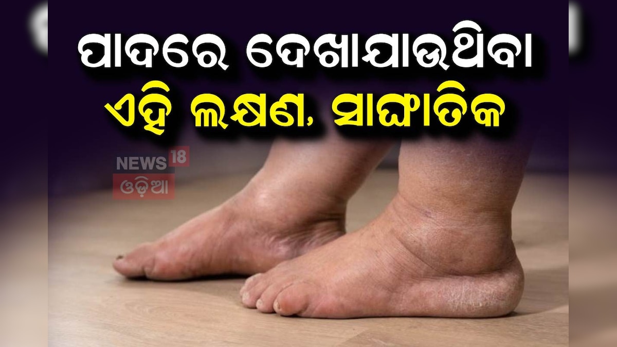 Feet Signs: ପାଦରେ ଦେଖାଯାଉଥିବା ଏହି ଲକ୍ଷଣ, ସାଙ୍ଘାତିକ ରୋଗର ସଙ୍କେତ... These ...