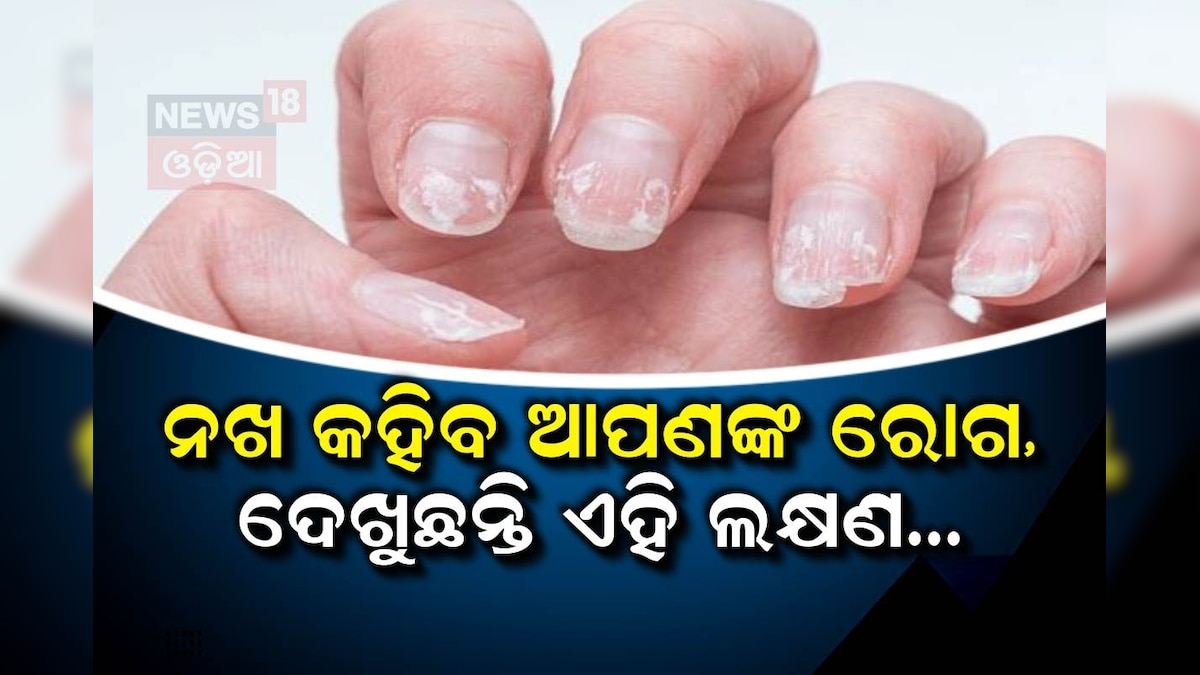 Nail Signs: ନଖ କହିବ ଆପଣଙ୍କ ରୋଗ; ଏହି ୭ଟି ସଙ୍କେତ ଭାରି ଖରାପ...nail signs ...