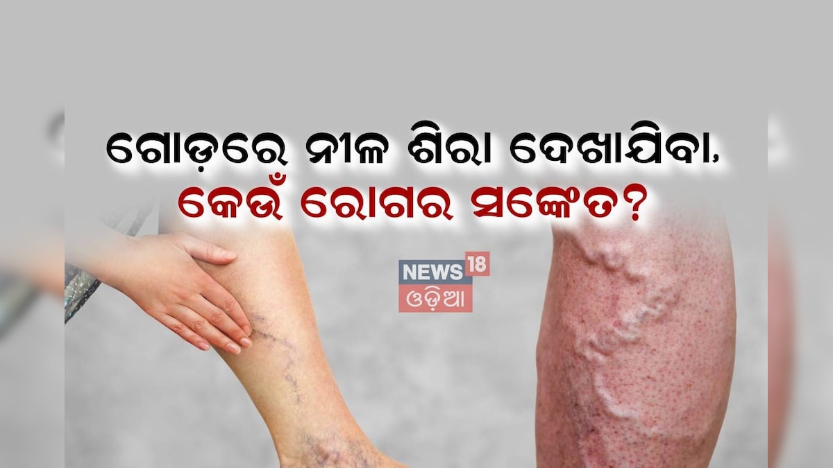 Blue Veins Reason: ଗୋଡ଼ରେ କାହିଁକି ଦେଖାଯାଏ ନୀଳ ଶିରା? ବଡ଼ ରୋଗର ସଙ୍କେତ ...