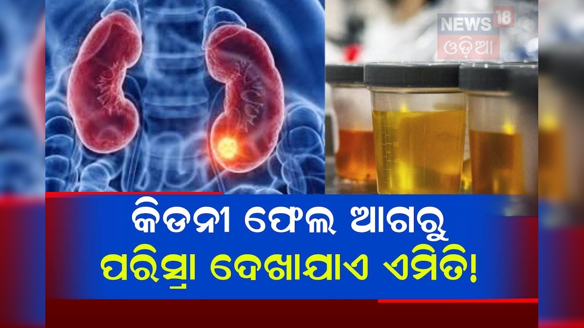 Kidney Failure: କିଡନୀ ଫେଲ୍ ହେବା ପୂର୍ବରୁ ପରିସ୍ରା ଦେଖାଯାଏ ଏମିତି! ଜାଣନ୍ତୁ ...