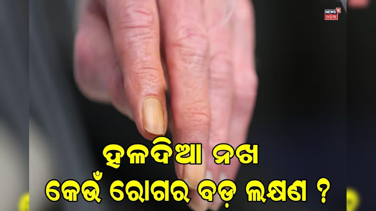 ସାବଧାନ; ନଖ ହଳଦିଆ ପଡ଼଼ିବା ଏହି ବଡ଼ ରୋଗର ଲକ୍ଷଣ! ଅଣଦେଖା କଲେ...If Your Nails ...
