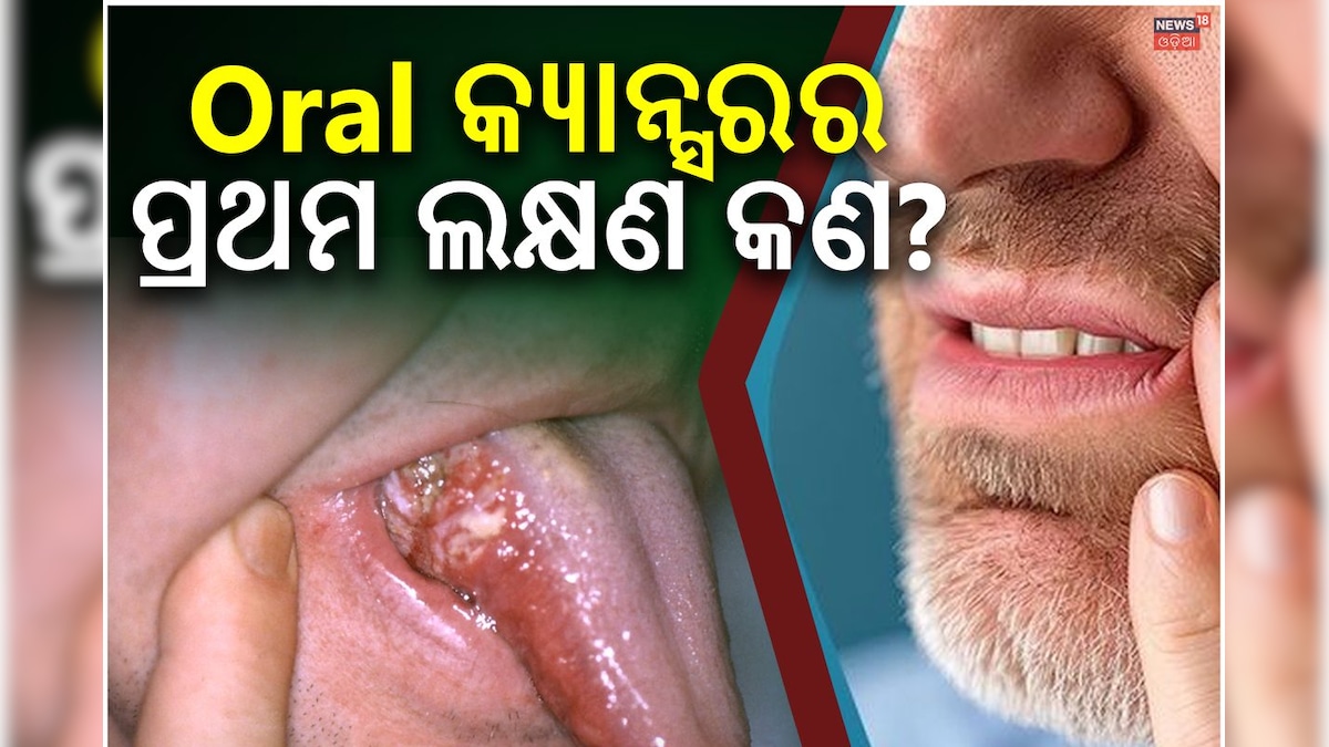 Oral Cancer: ପାଟି କ୍ୟାନ୍ସରରେ ଦେଖାଯାଏ ଏହି ଲକ୍ଷଣ! ଅଣଦେଖା କଲେ ଭୋଗିବେ ...