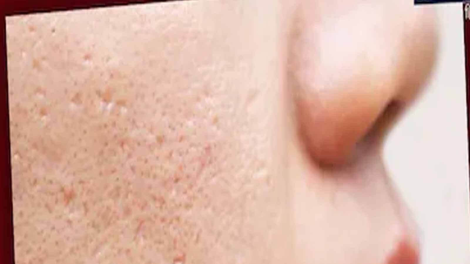 ਤੁਹਾਨੂੰ ਹੈ 'Chicken Skin' ਦੀ ਸਮੱਸਿਆ, ਤਾਂ ਜਾਣੋ ਬਚਣ ਲਈ ਘਰੇਲੂ ਉਪਾਅ If you ...