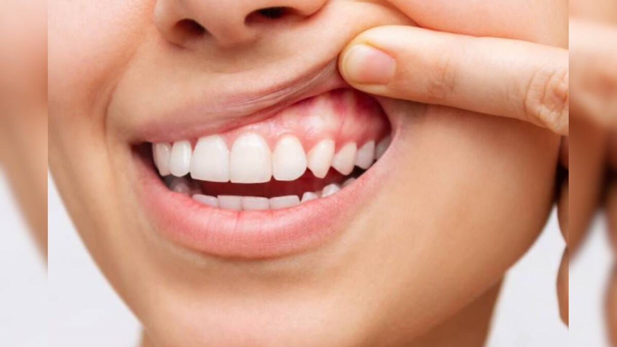 health home remedies for bleeding gum besharam plant cure for teeth ...