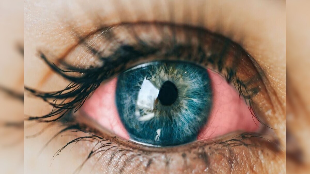 ਅੱਖਾਂ ਦੀ ਰੌਸ਼ਨੀ ਵੀ ਖੋਹ ਲੈਂਦੀ ਹੈ ਇਹ ਬਿਮਾਰੀ, AIIMS ਨੇ ਪਹਿਲੀ ਵਾਰ ਕੀਤੀ ...